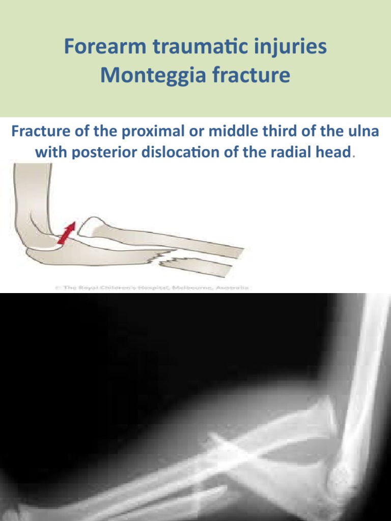 Forearm Traumatic Injuries Lecture 6 | Download Free PDF ...