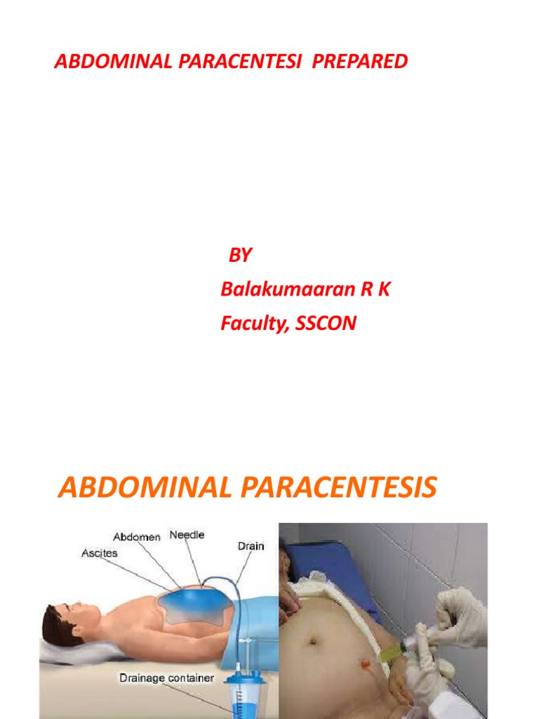 Abdominal Paracentesis | PDF | Syringe | Clinical Medicine