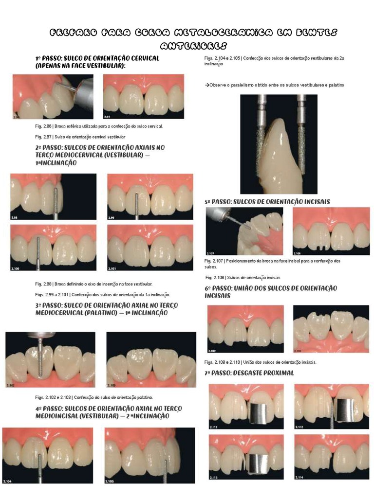 Preparo para Coroa Metalocerâmica em Dentes Anteriores | PDF | Boca ...
