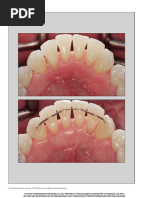 Miller Classification of Marginal Tissue | PDF | Periodontology ...