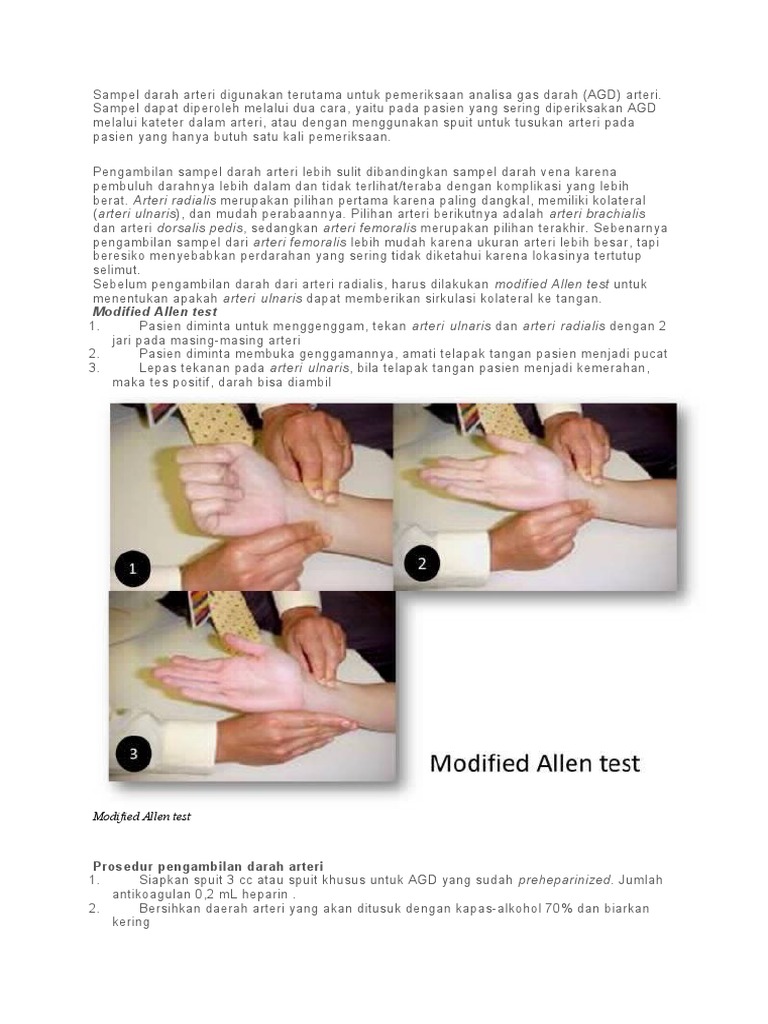 Modified Allen Test | PDF