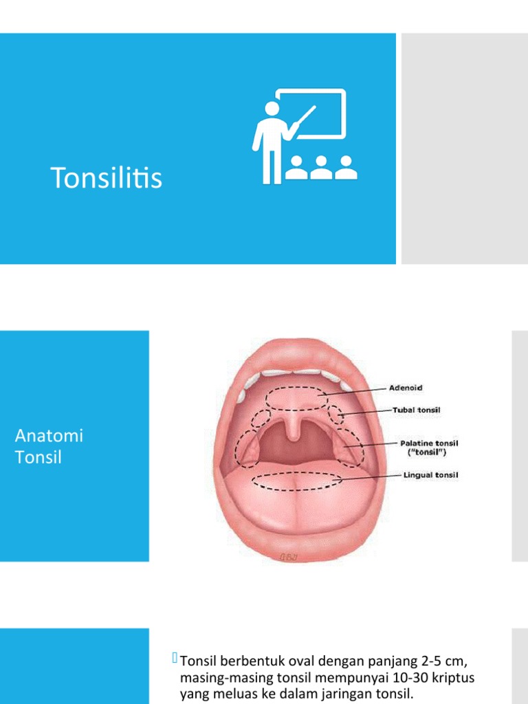 THT Tonsilitis | PDF