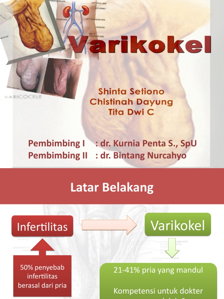 Varikokel | PDF