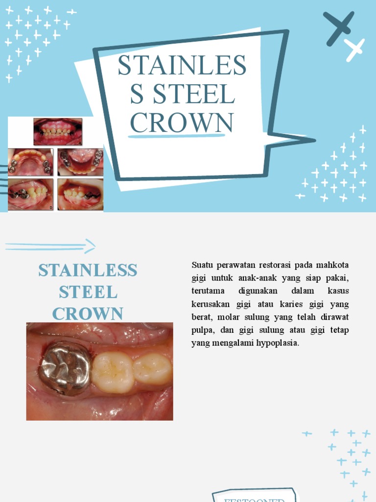 Stainless Steel Crown | PDF