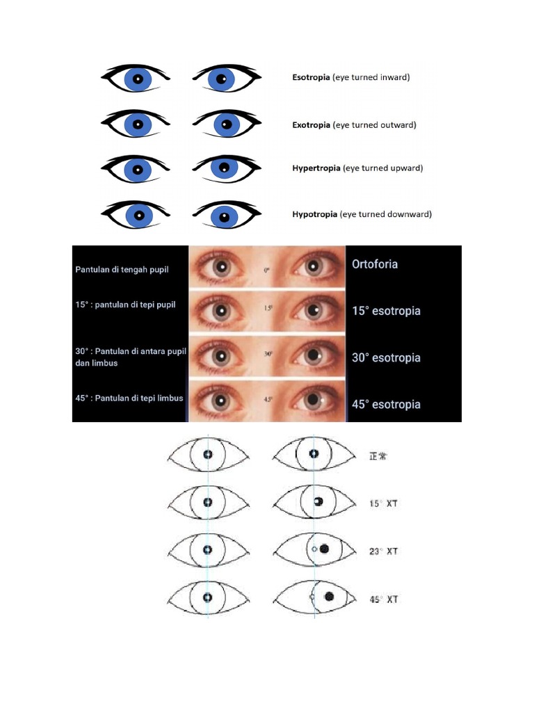 Hirschberg Test | PDF