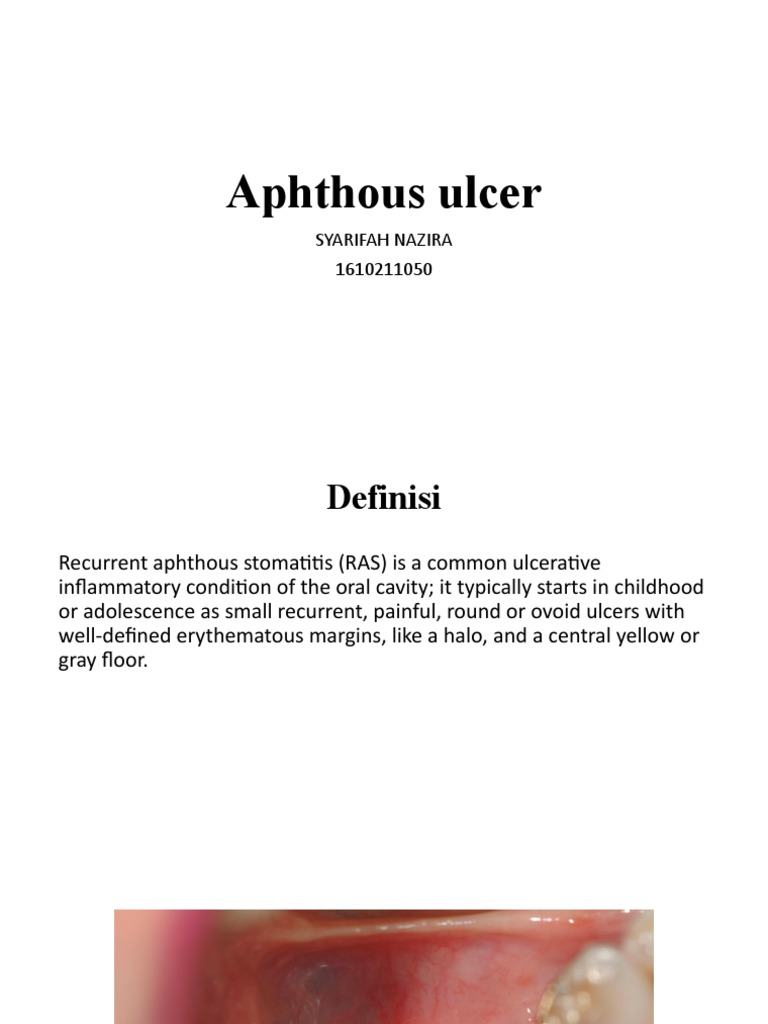 Aphthous Ulcer | PDF | Medical Specialties | Epidemiology