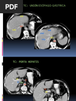 Anatomia Normal Del Higado | PDF | Vena | Sistema cardiovascular