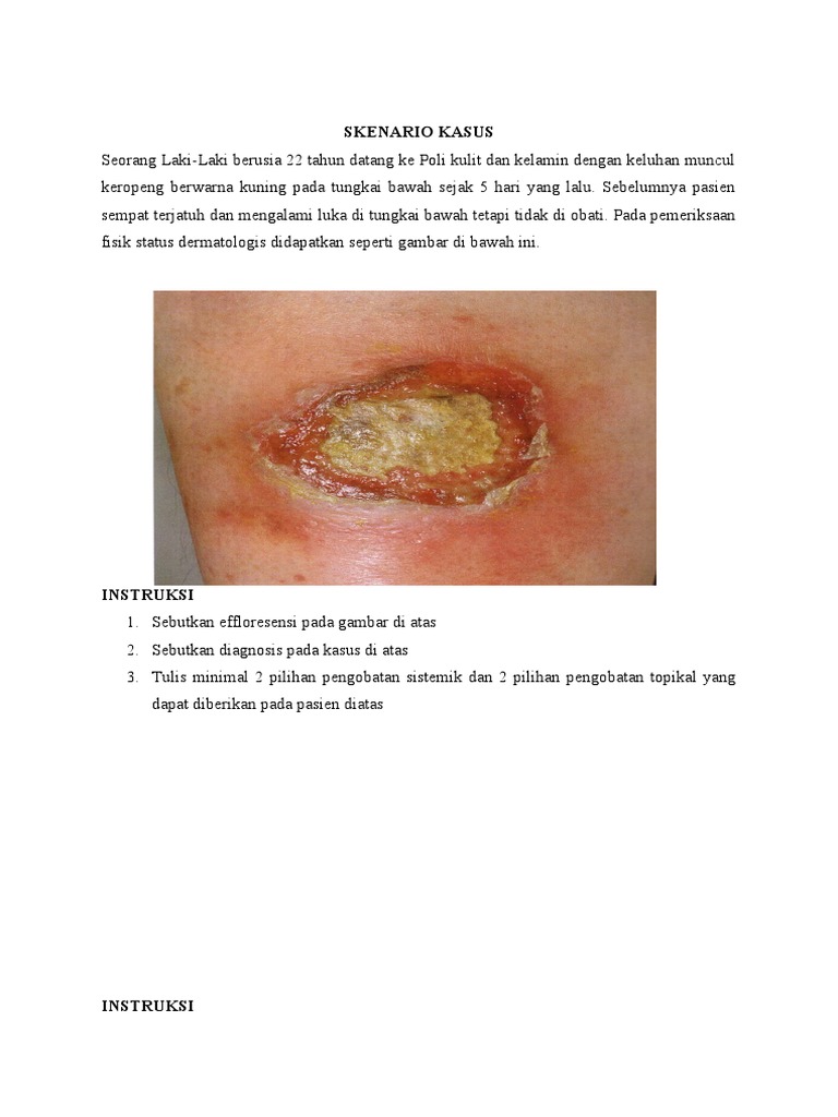 Diagnosis dan Terapi Ektima pada Kulit | PDF