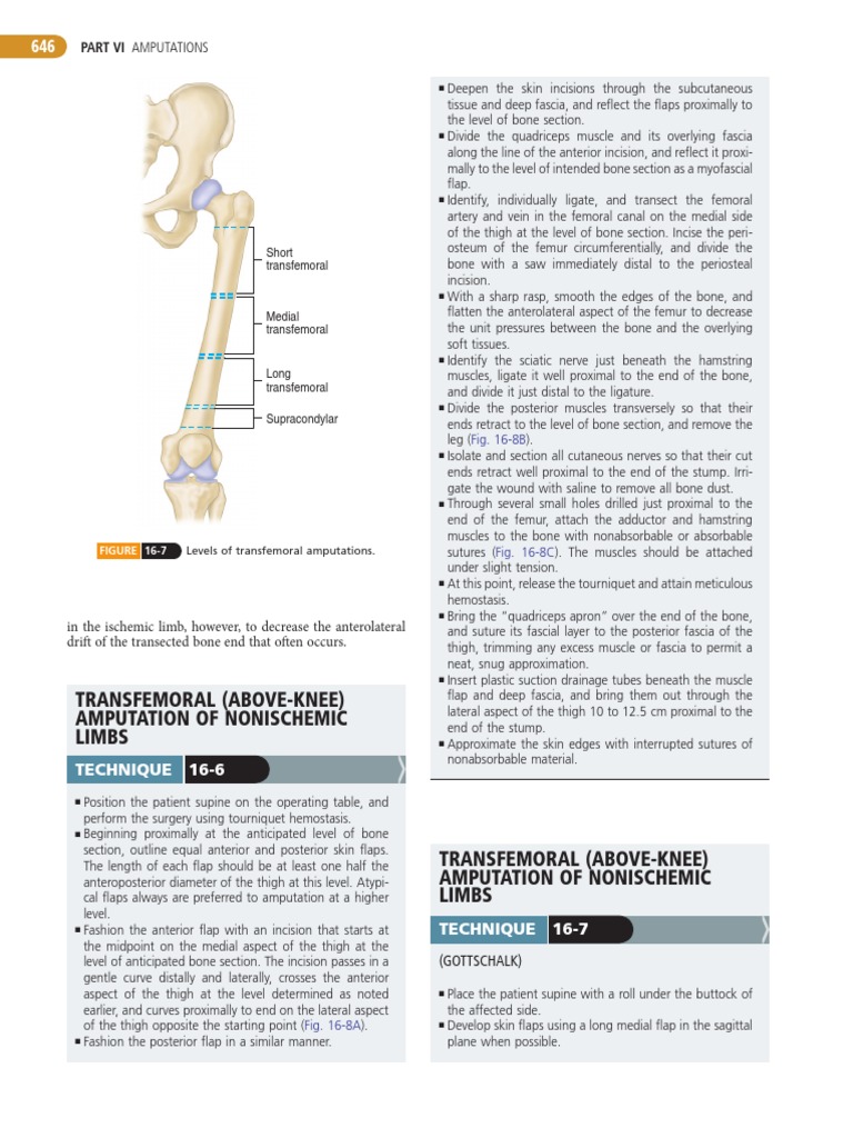 Transfemoral (Above-Knee) Amputation of Nonischemic Limbs: Part Vi ...