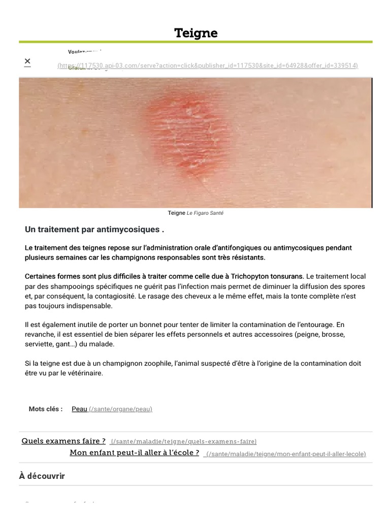 Teigne - Quel Traitement ? - Fiches Santé Et Conseils Médicaux | PDF ...