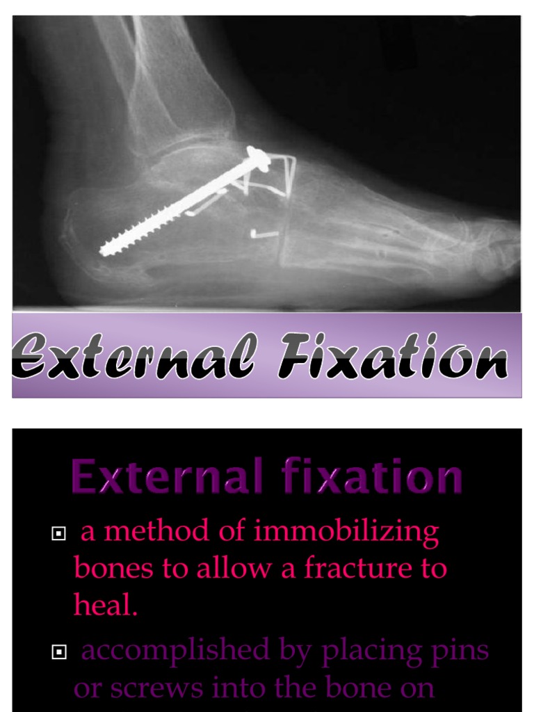 External Fixation | PDF | Medical Specialties | Clinical Medicine