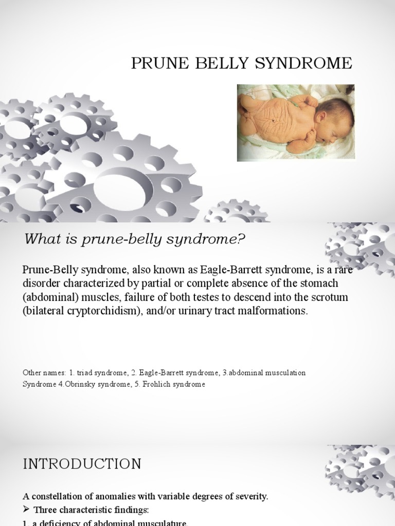 Prune Belly Syndrome | PDF | Urology | Genitourinary System