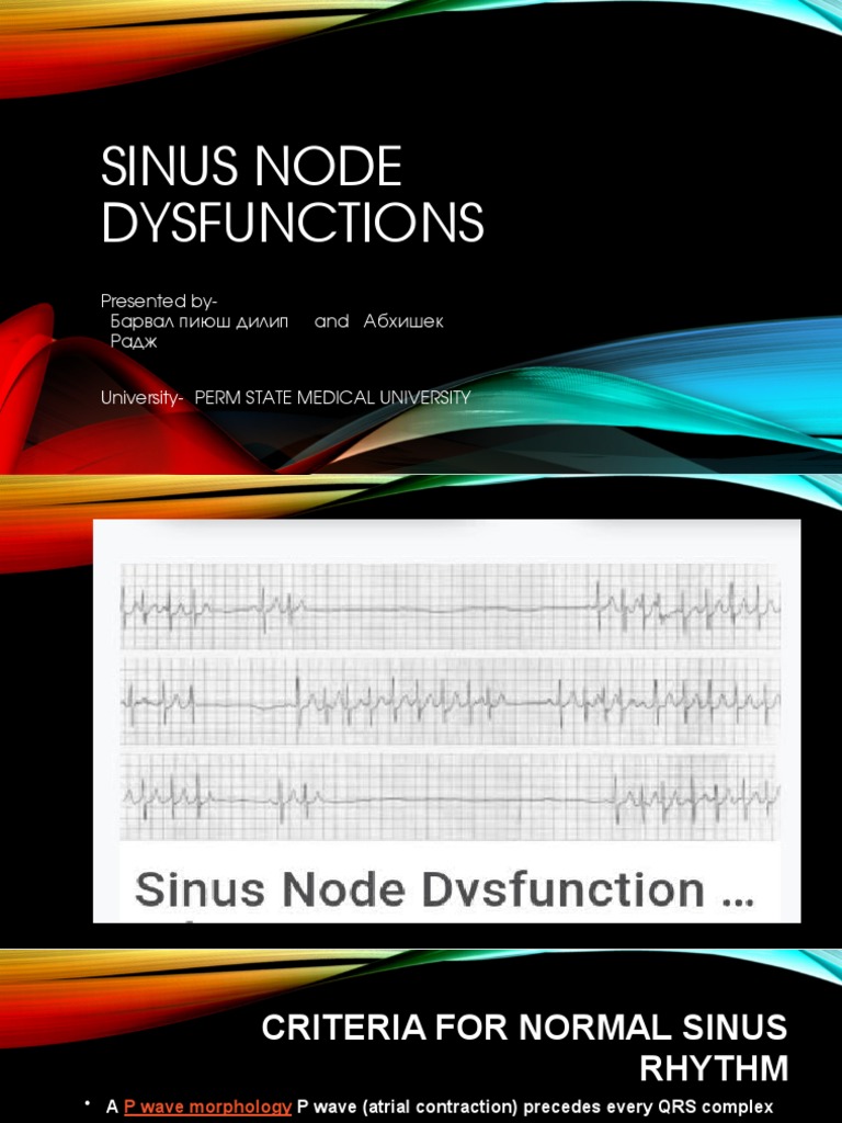 Sinus Node Dysfunction Overview | PDF | Electrocardiography ...
