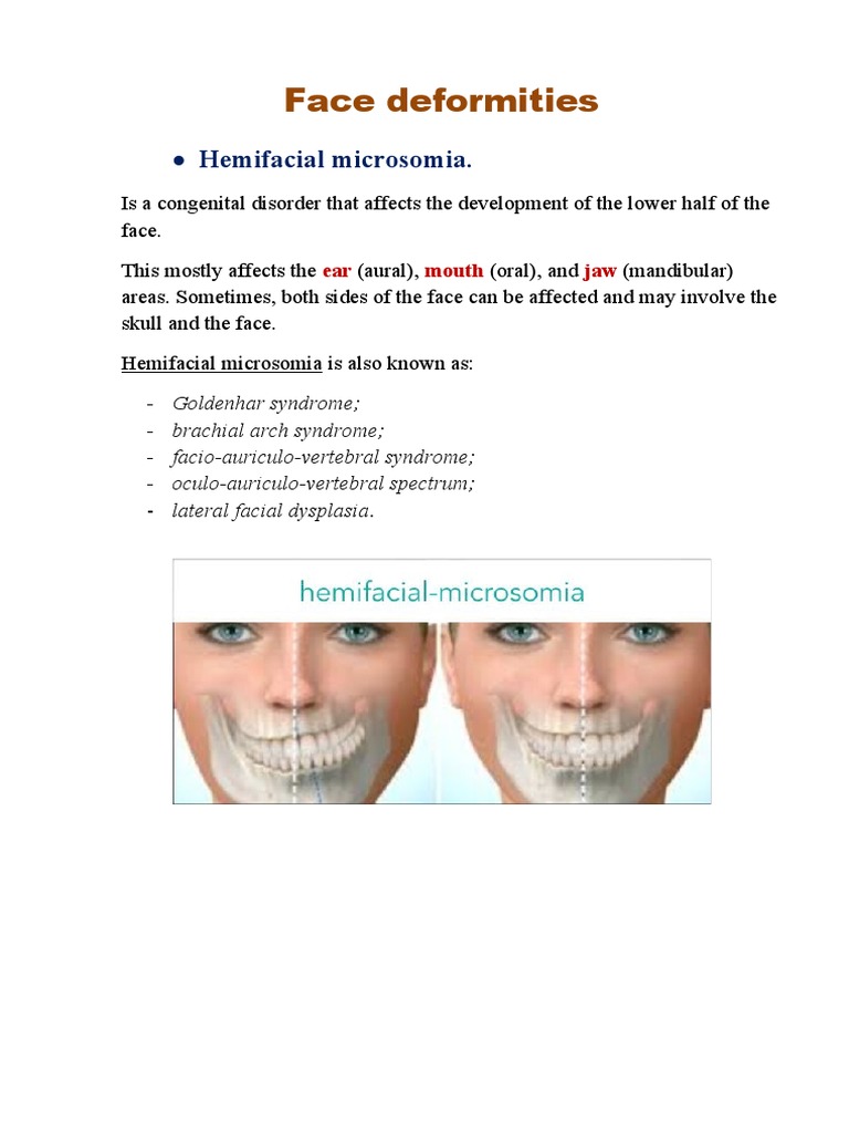 Face Deformities: Hemifacial Microsomia | PDF | Politics | Science ...
