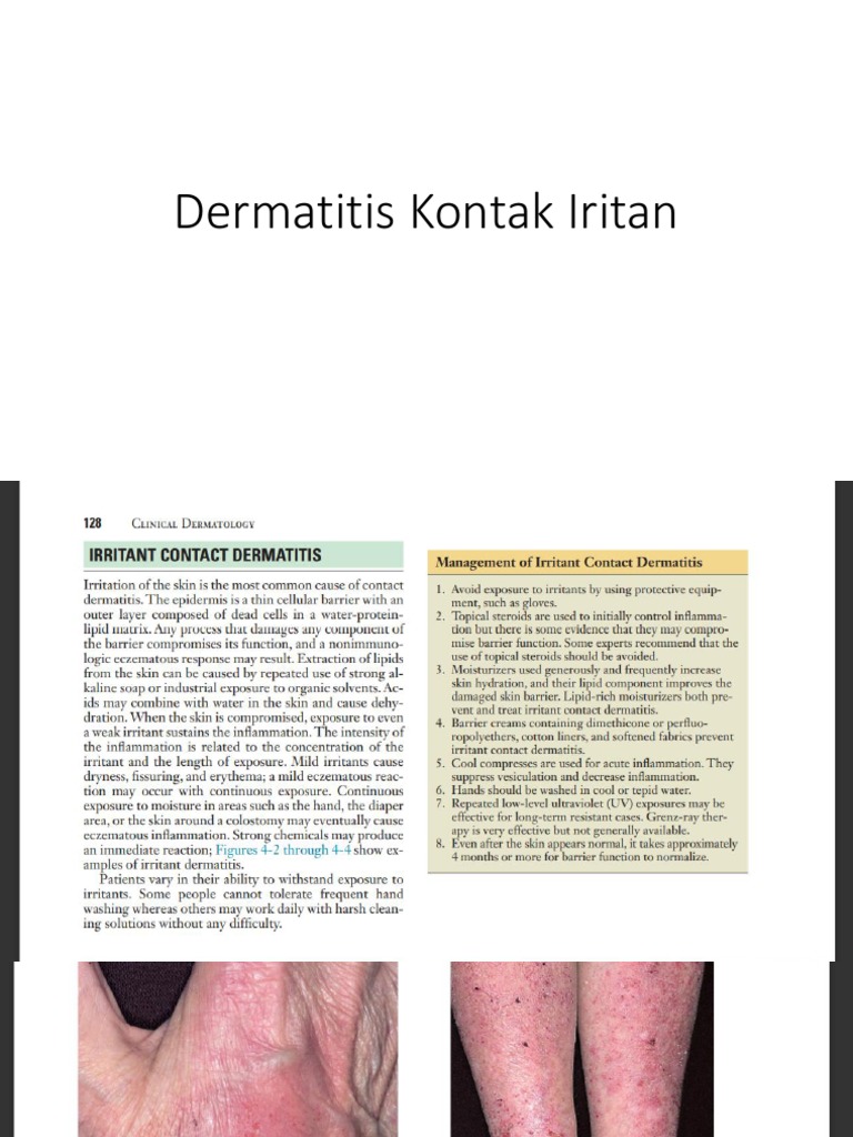 Dermatitis Kontak Iritan | PDF