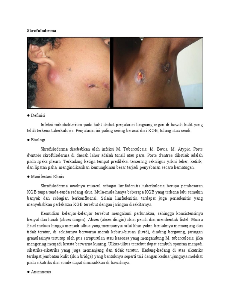 Skrofuloderma, KSS, Filariasis | PDF