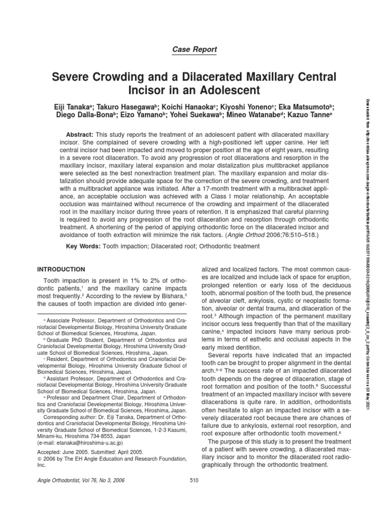 Severe Crowding and A Dilacerated Maxillary Central Incisor in An ...