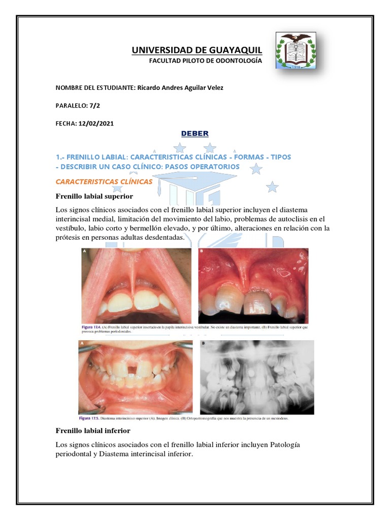 Clasificación y tratamiento de frenillos | PDF | Boca | Anatomía humana