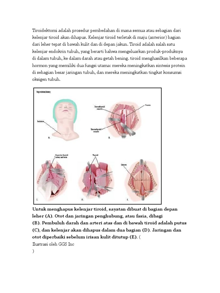 Tiroidektomi Adalah Prosedur Pembedahan Di Mana Semua Atau Sebagian ...