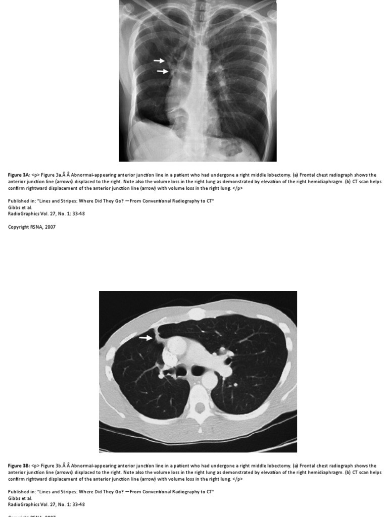 Lines | PDF | Radiography | Ct Scan