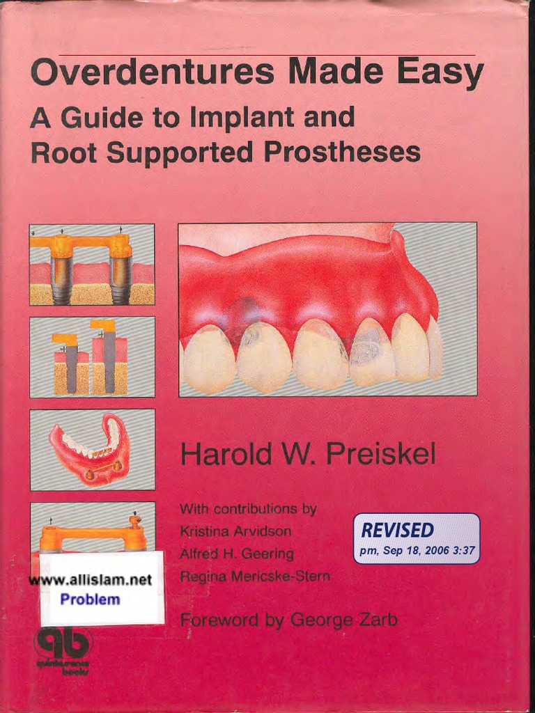 Overdentures Made Easy A Guide To Implant and Root Supported Prostheses ...