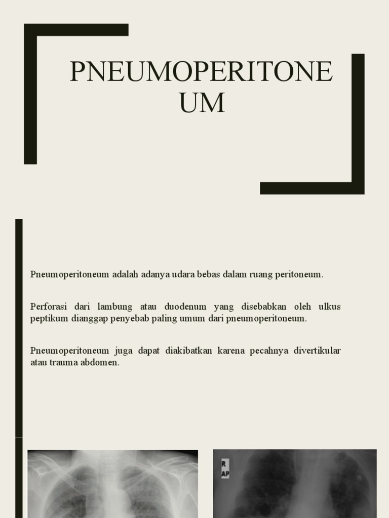 Pneumoperitoneum: Tanda dan Penyebab | PDF | Perjalanan