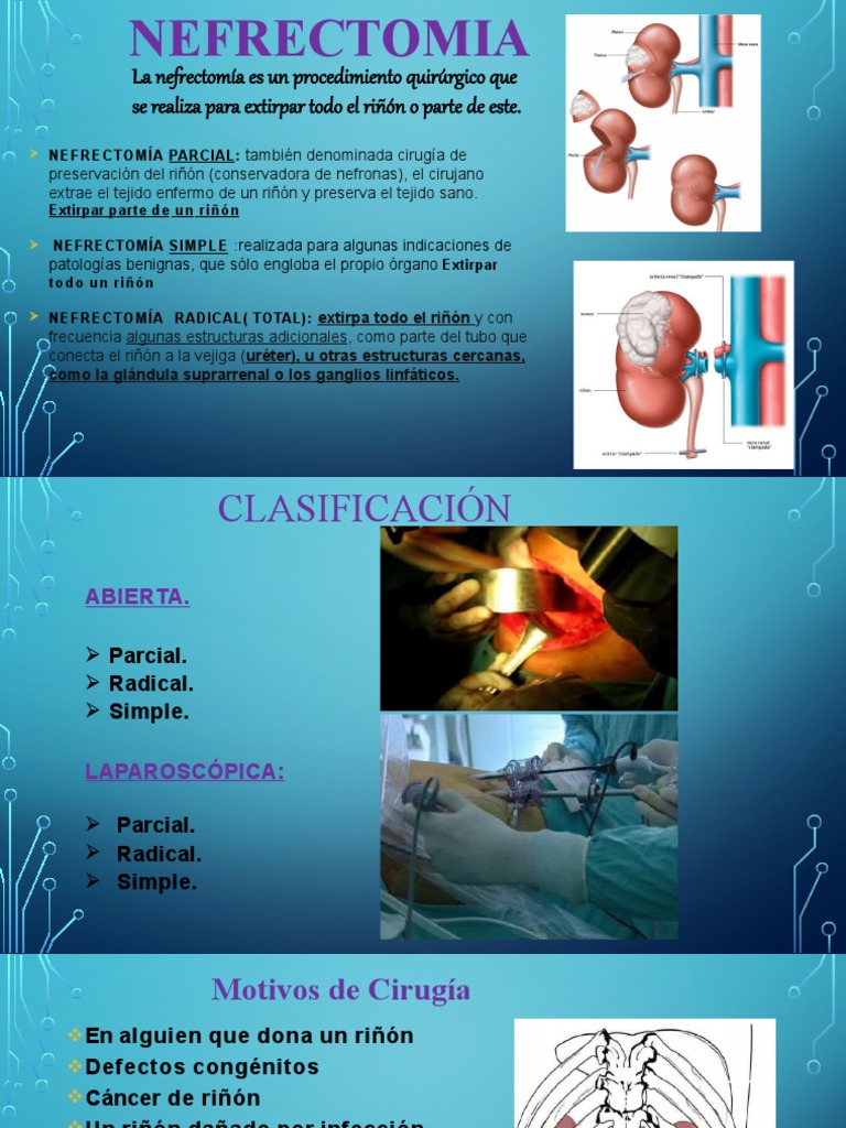 Procedimiento quirúrgico para la extirpación del riñón: Nefrectomía ...