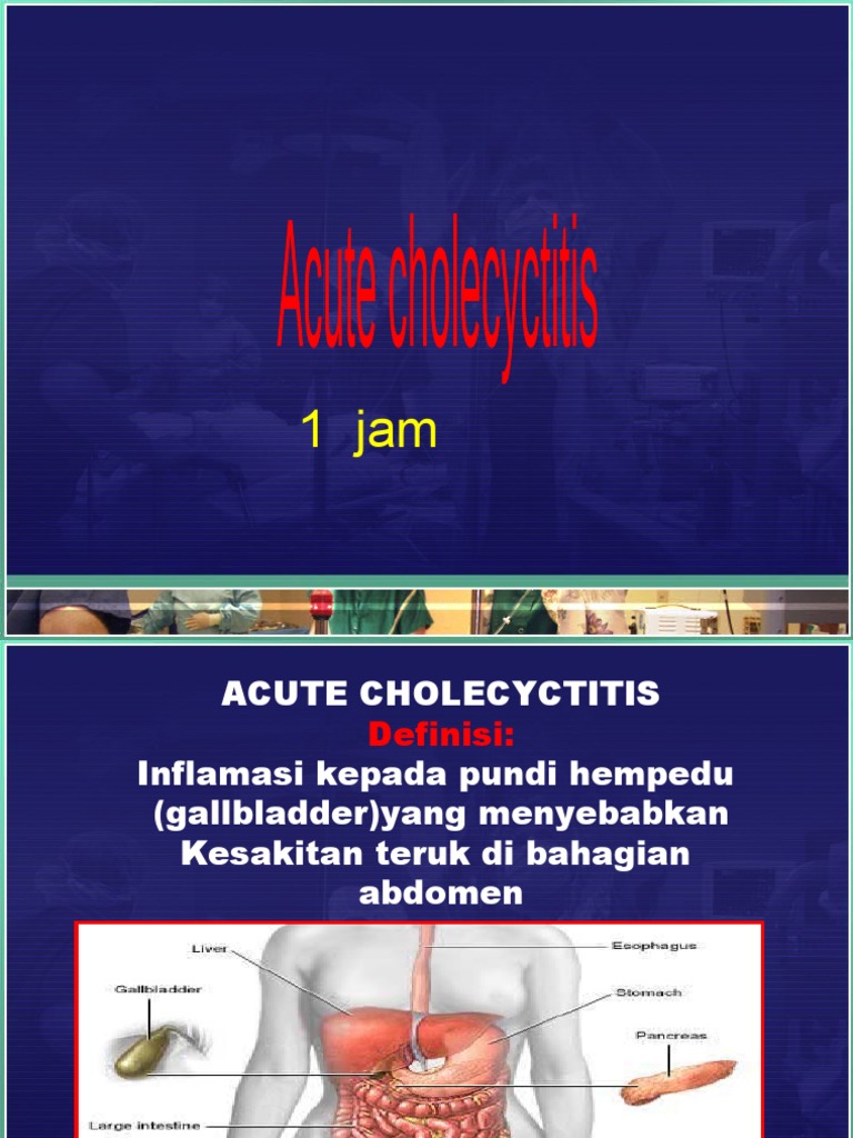 18.acute Cholecystitis | PDF