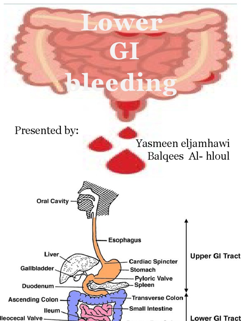 Lower GI Bleeding Slide | PDF | Hemorrhoid | Colonoscopy