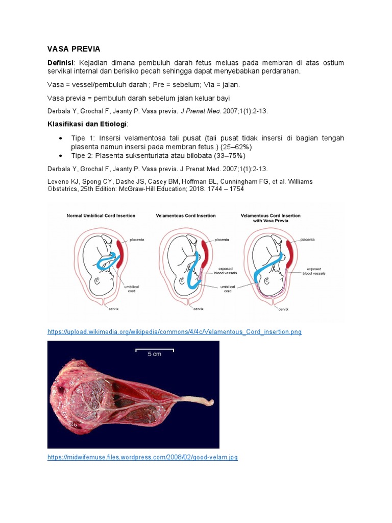 Vasa Previa | PDF