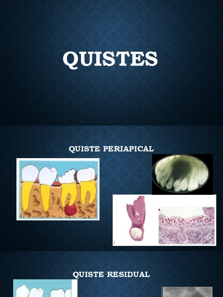Tipos de Quistes Odontológicos | PDF | Cocina, comidas y vino | Salud y ...
