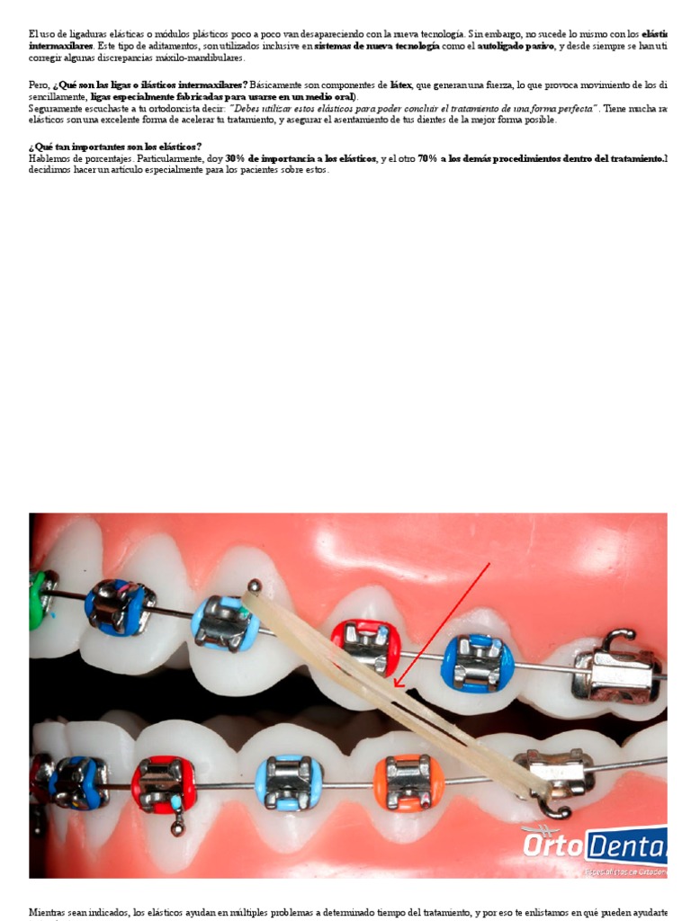 La Importancia de Usar Elásticos Intermaxilares en Ortodoncia | PDF ...