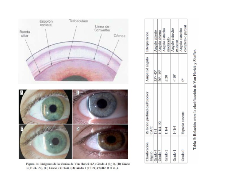 Van Herick VS Shaffer | PDF