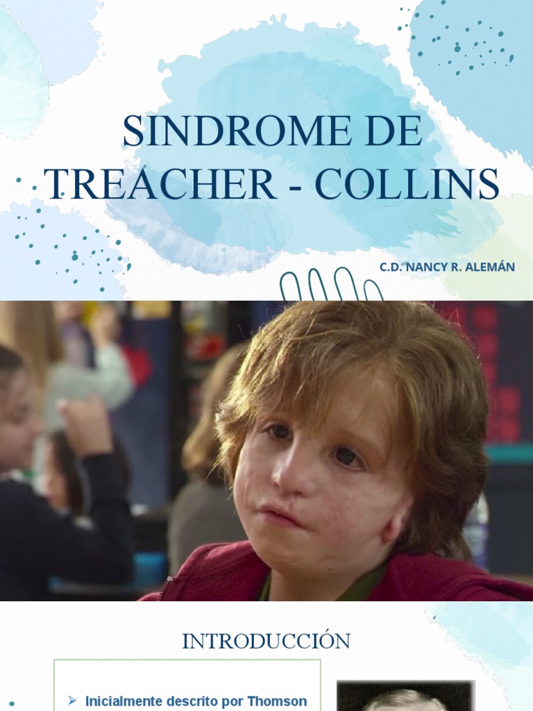 Síndrome de Treacher Collins: Características y Tratamiento | PDF ...