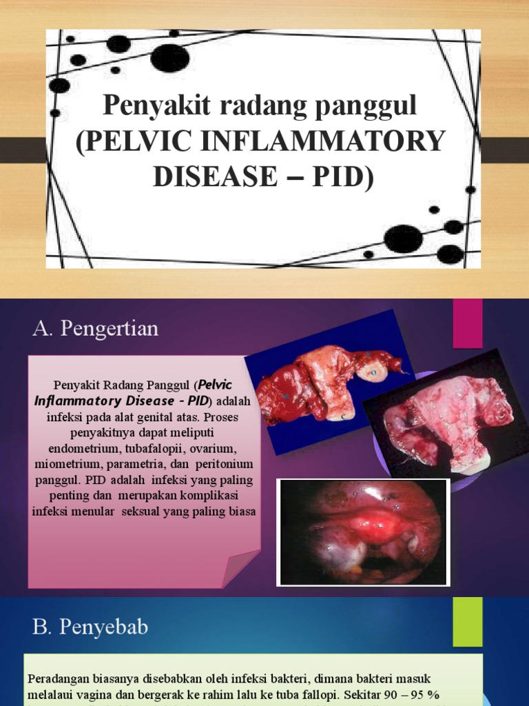 Penyakit Radang Panggul Pid 2021 | PDF