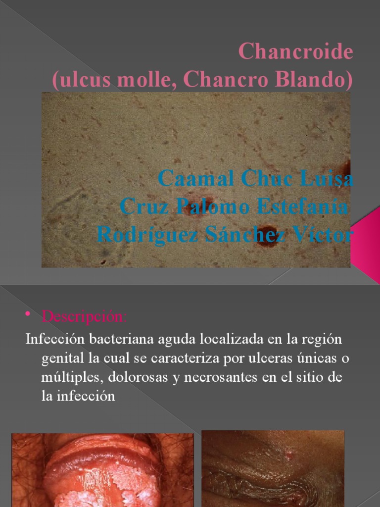 Chancroide | PDF