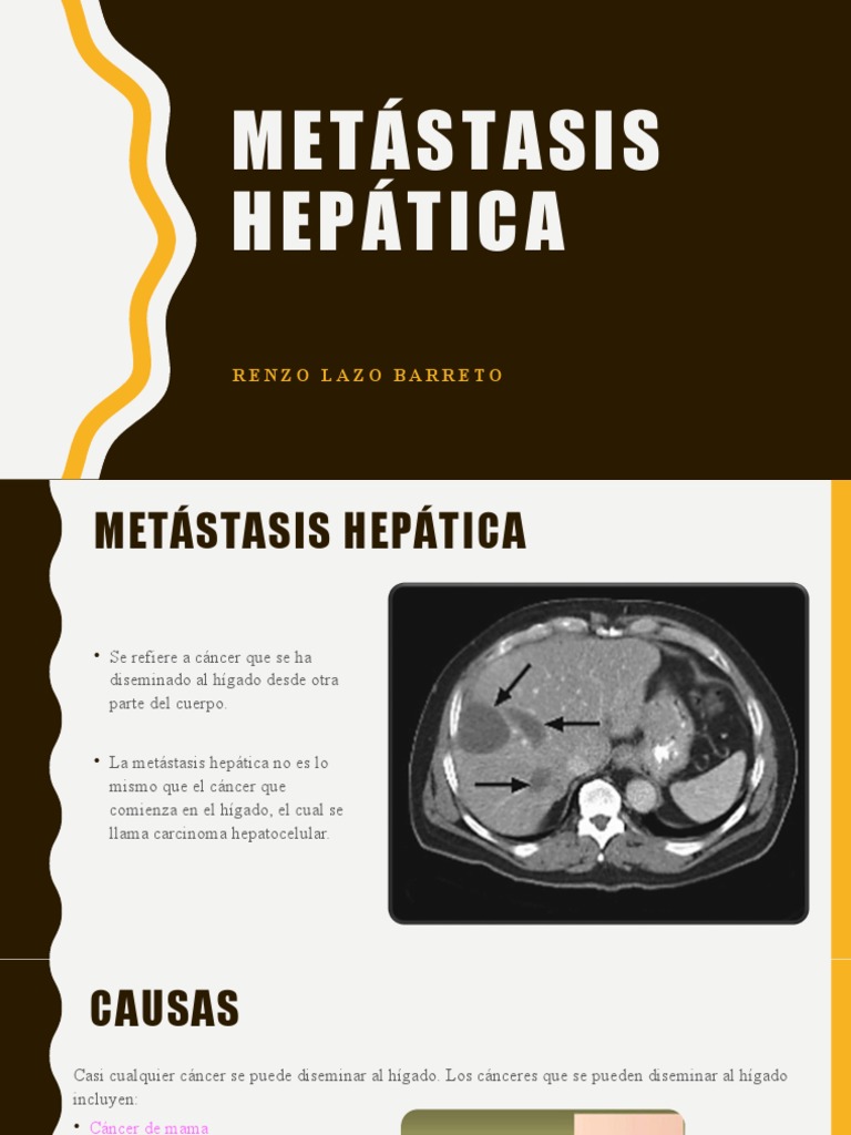 Metástasis Hepática | PDF | Metástasis | Cáncer
