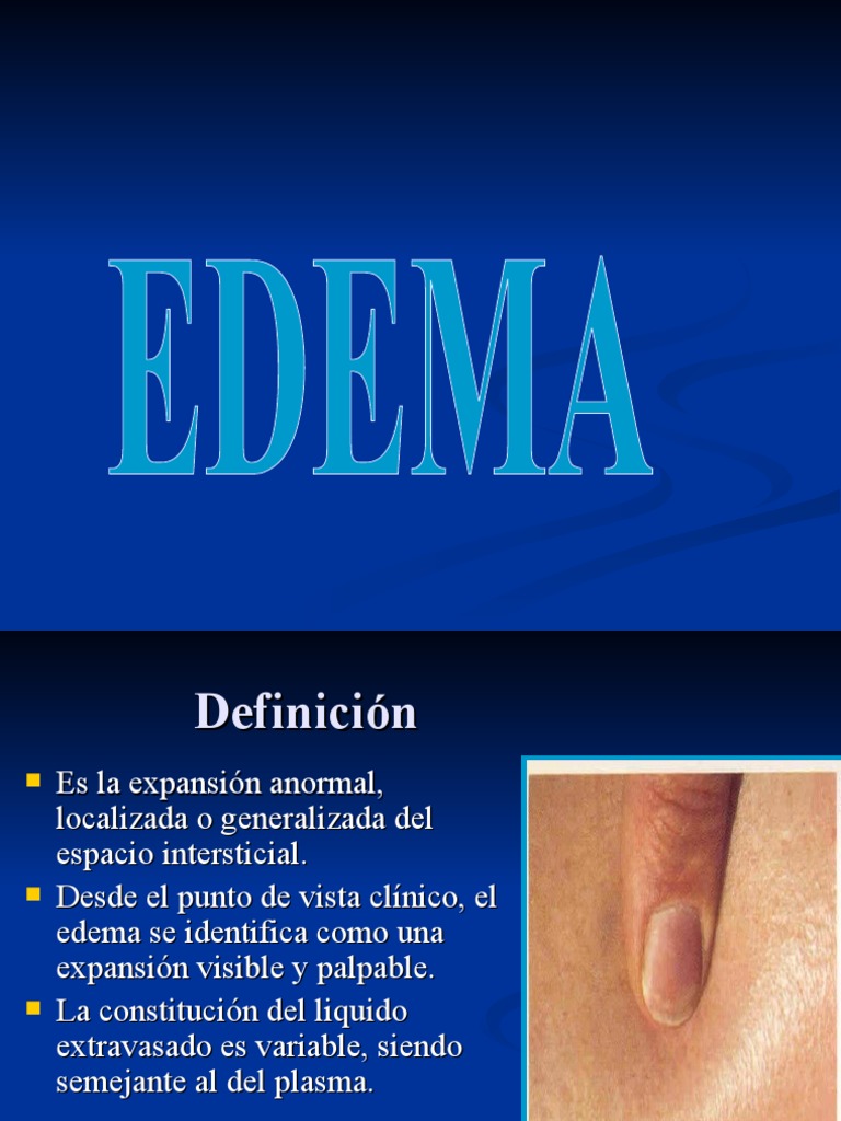Definición y clasificación del edema | PDF | Edema | Rtt