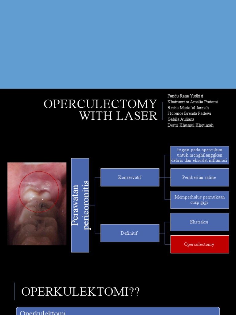 Operculectomy With Laser | PDF