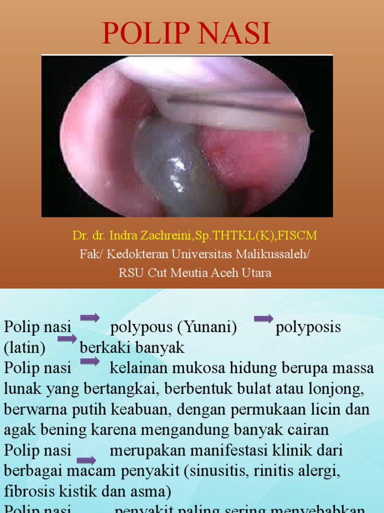 Polip Nasi | PDF