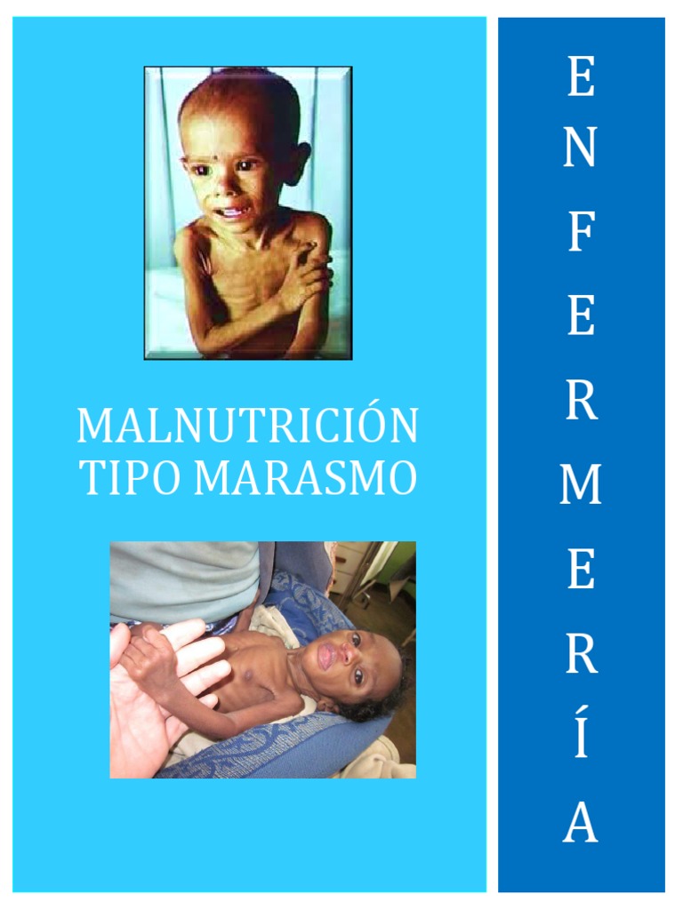 Desnutrición Infantil Marasmo Y Tratamiento Pdf Nutrición Dieta