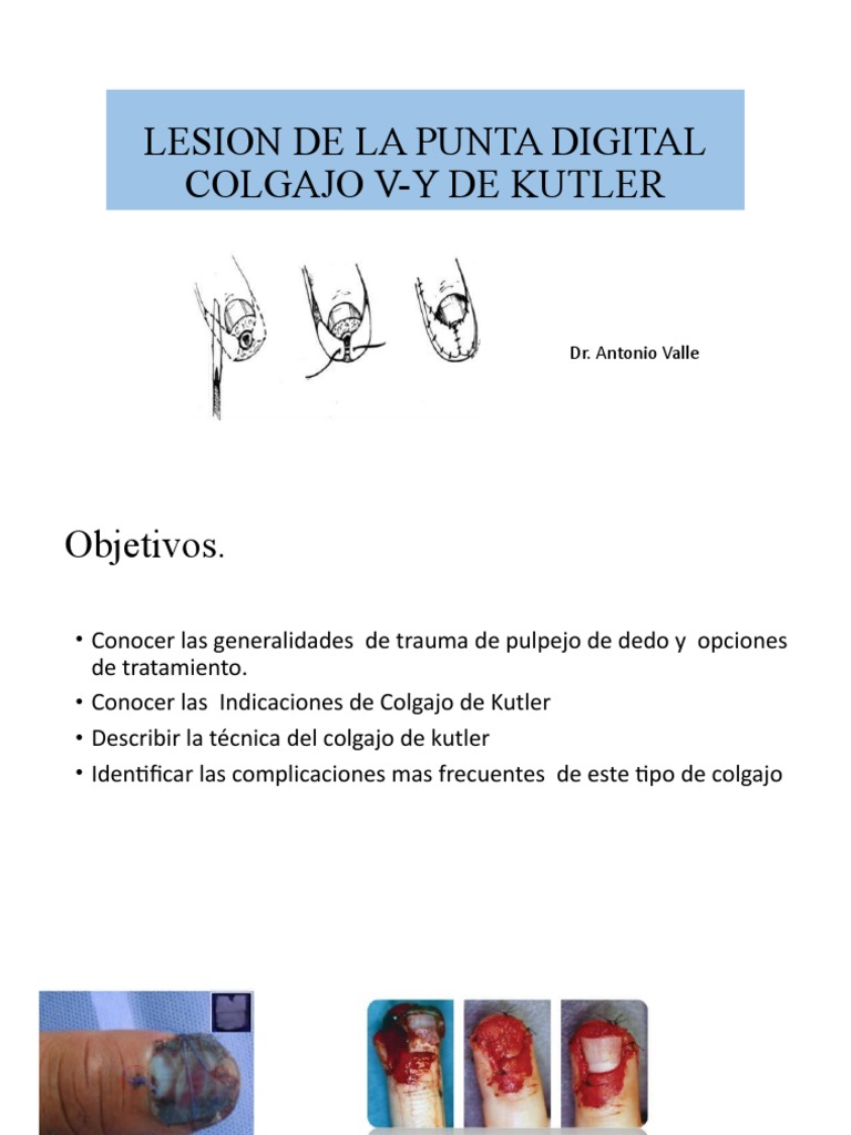 V-Y Kutler | PDF | Mano | Medicina