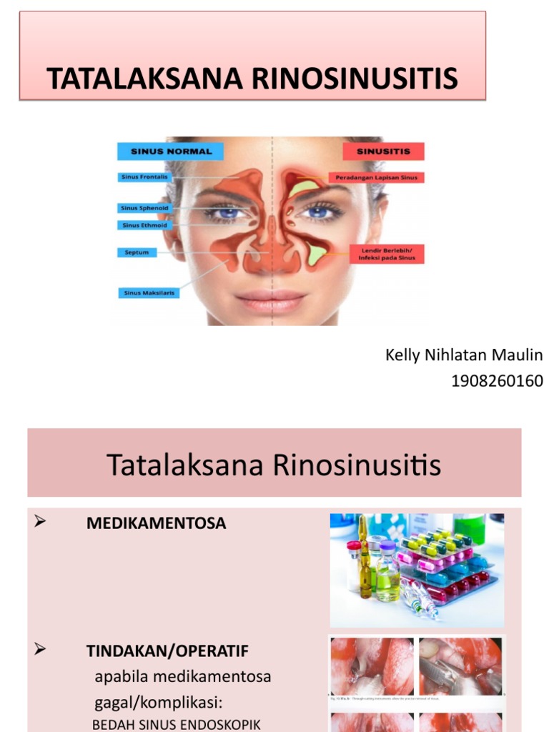 TATALAKSANA Rhinosinusitis | PDF | Kesehatan Holistik