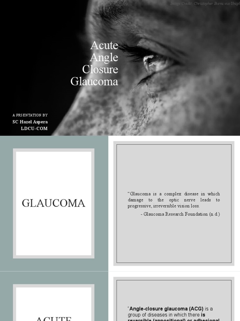 Appositional Angle Closure Glaucoma | PDF | Glaucoma | Facial Features