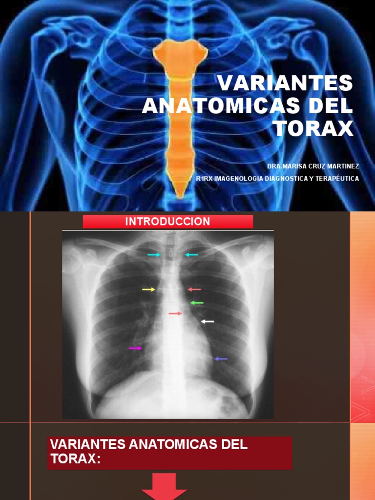 Variantes Anatomicas Del Torax | PDF | Tórax | Sistema musculoesquelético