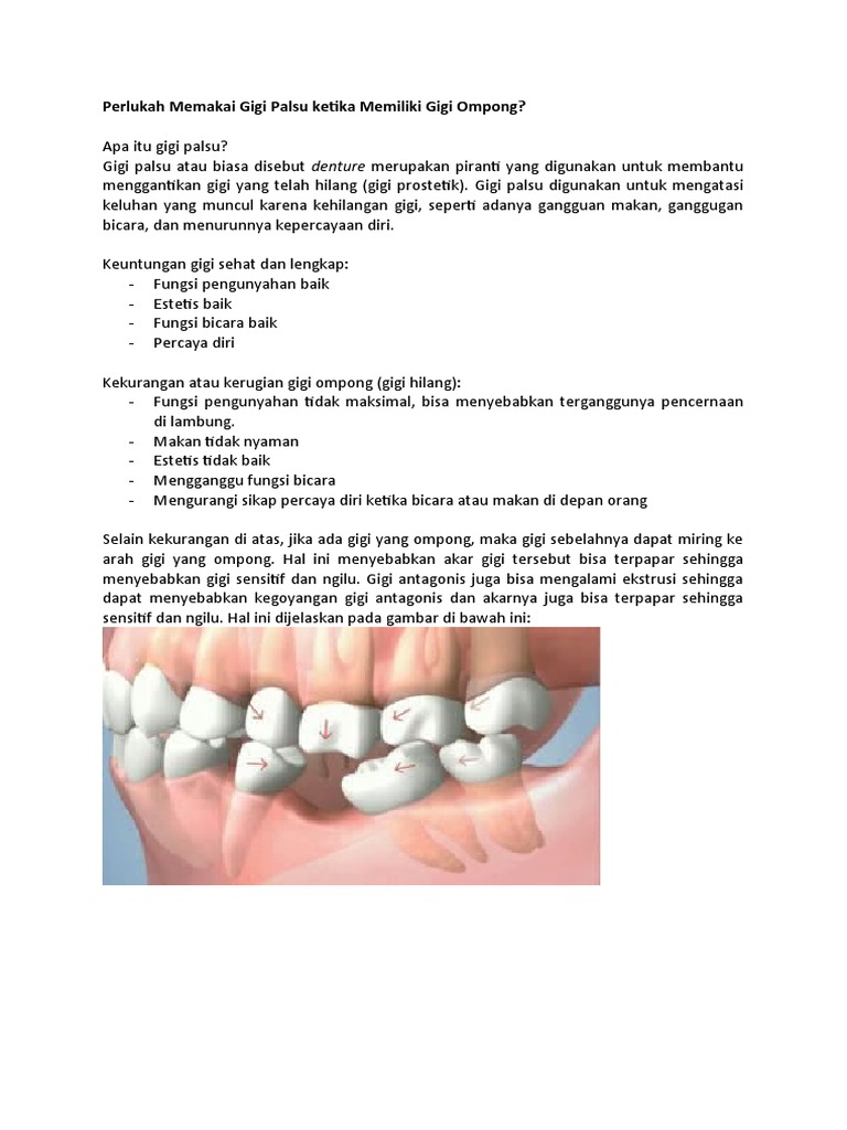 Gigi Palsu untuk Gigi Ompong: Panduan | PDF