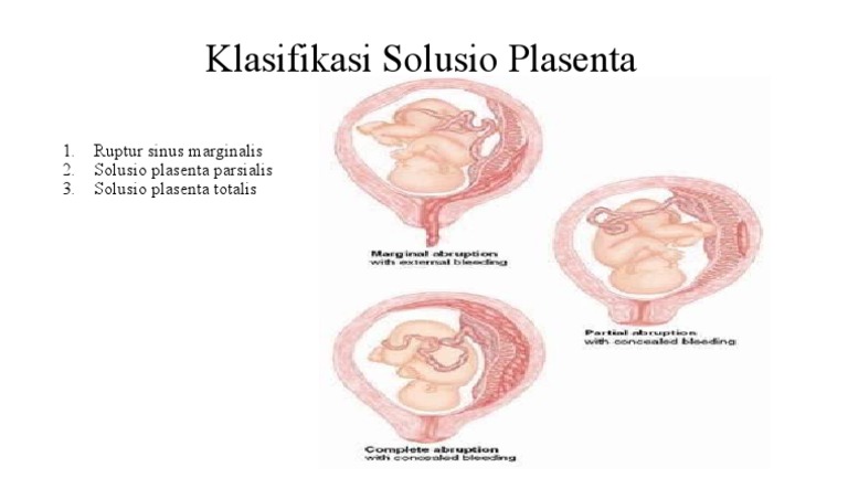 Solusio Plasenta GAMBARAN RADIOLOGI ULTRASONOGRAFI PADA KELAINAN