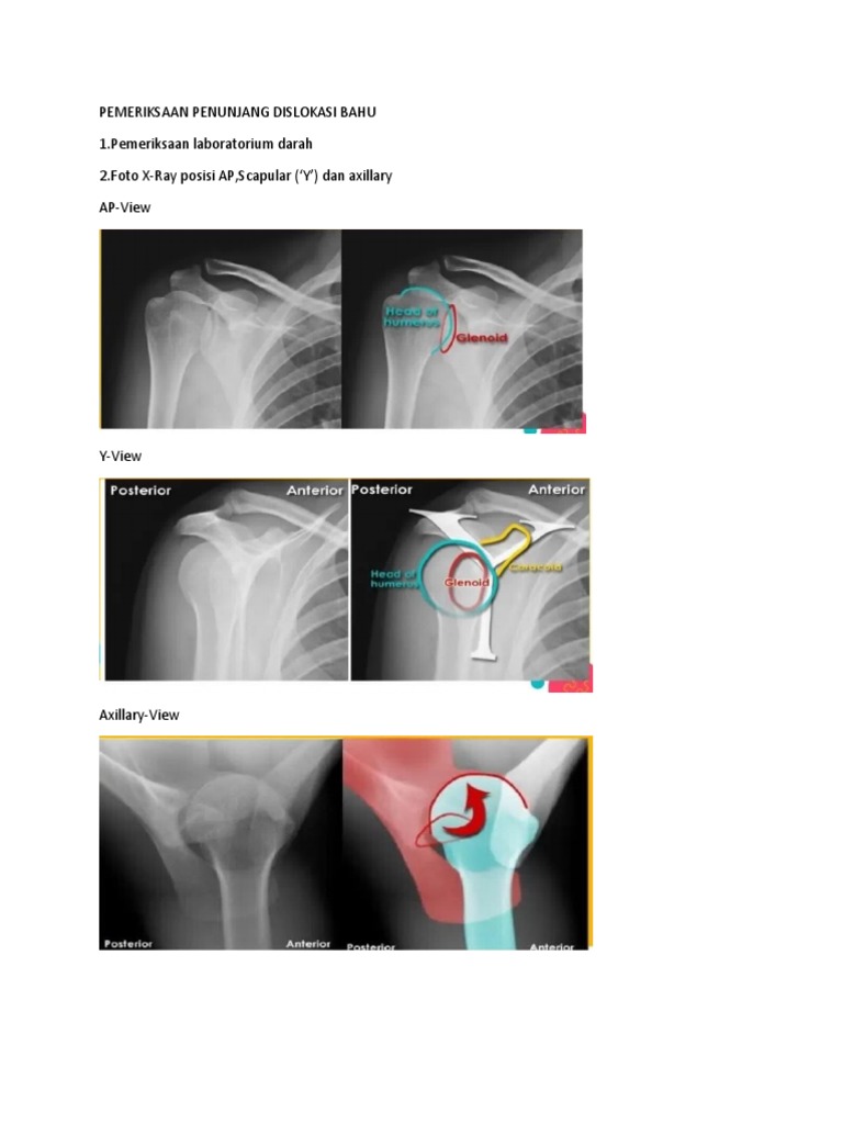 Pemeriksaan Penunjang Dislokasi Bahu | PDF