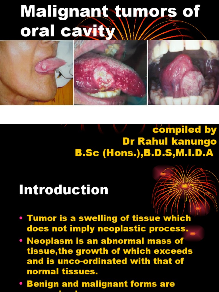 Malignant Oral Tumors Overview | PDF | Melanoma | Metastasis
