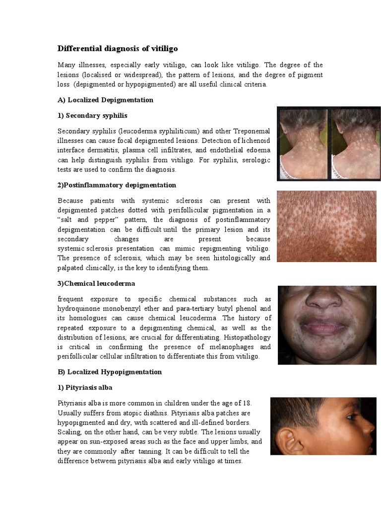 Differential Diagnosis of Vitiligo: A) Localized Depigmentation 1 ...